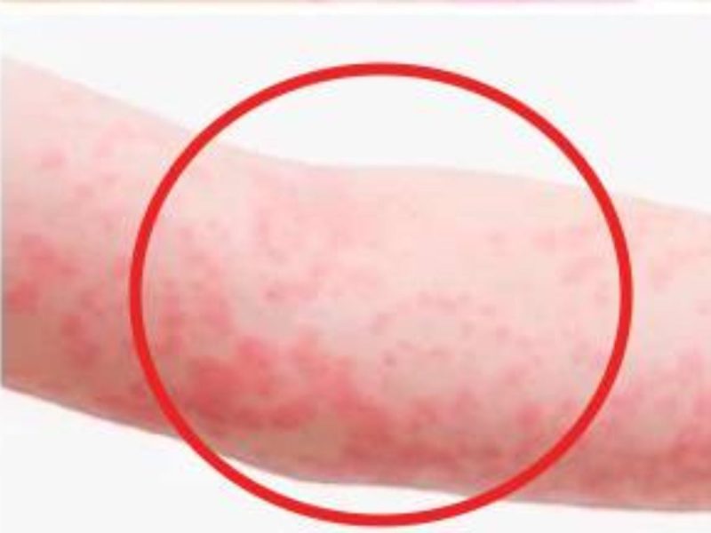 MUERE UNA MENOR POR SARAMPIÓN: SECRETARÍA DE SALUD - ENCORTO NEWS